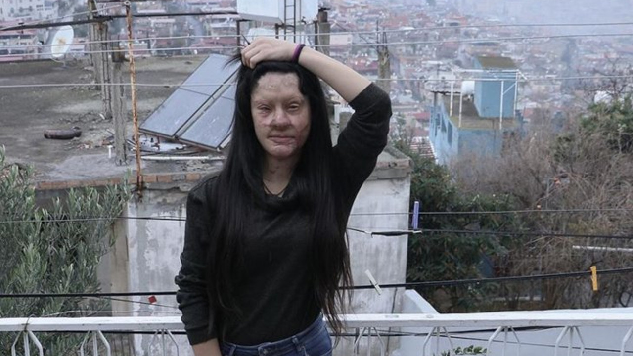 Turkish woman who survived acid attack forgives perpetrator ex-boyfriend